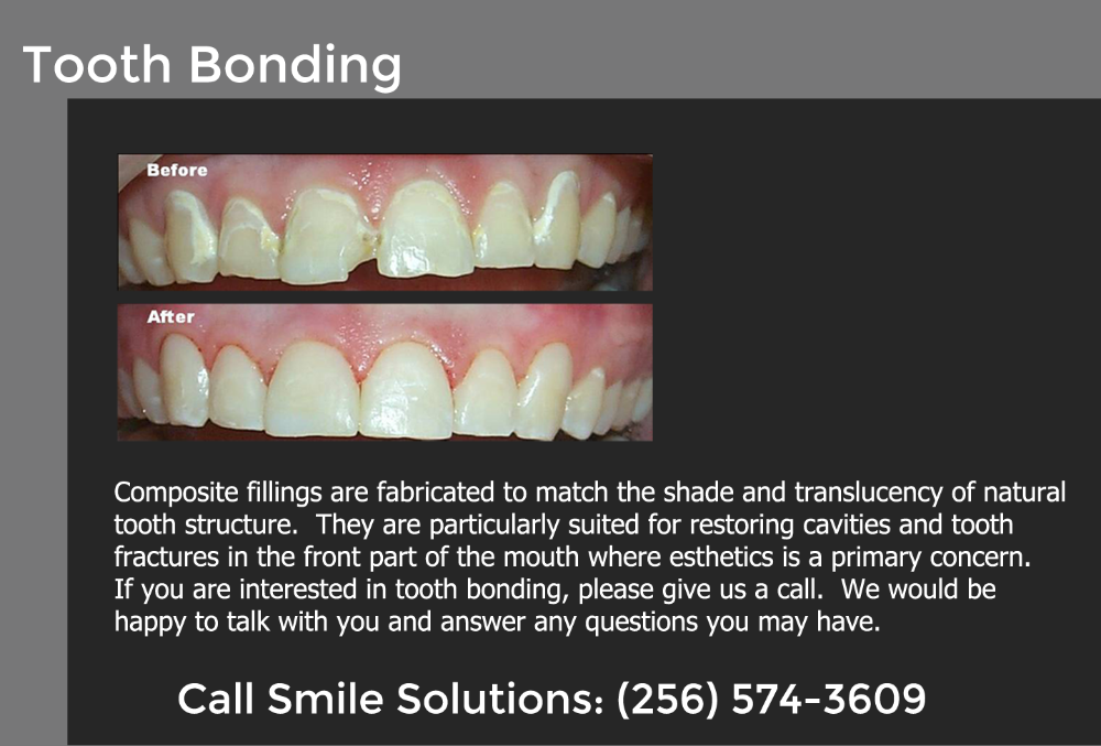 Tooth Bonding Scottsboro AL | Smile Solutions